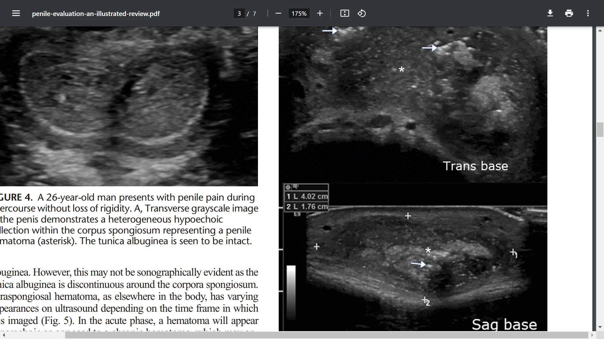 High-frequency ultrasound for penile evaluation in ED diagnosis | Excel ...