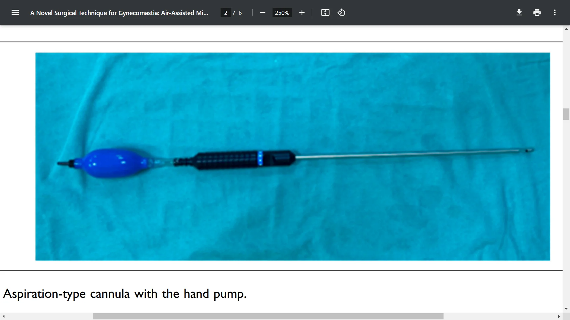 Gynecomastia: Air-Assisted Minimally Invasive Surgery | Excel Male TRT ...