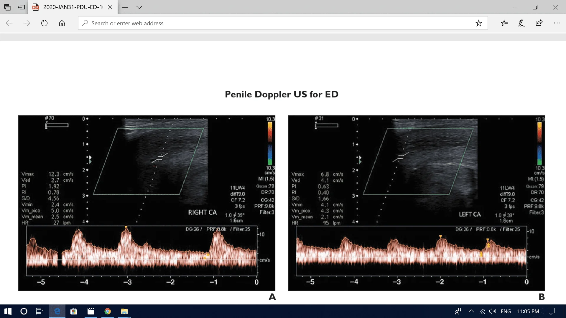 Penile Doppler Ultrasound for Erectile Dysfunction: | Excel Male TRT Forum