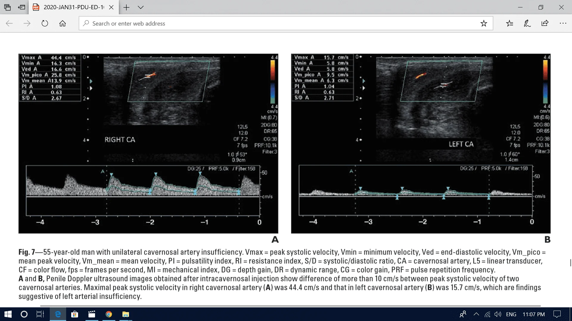 Penile Doppler Ultrasound for Erectile Dysfunction: | Excel Male TRT Forum