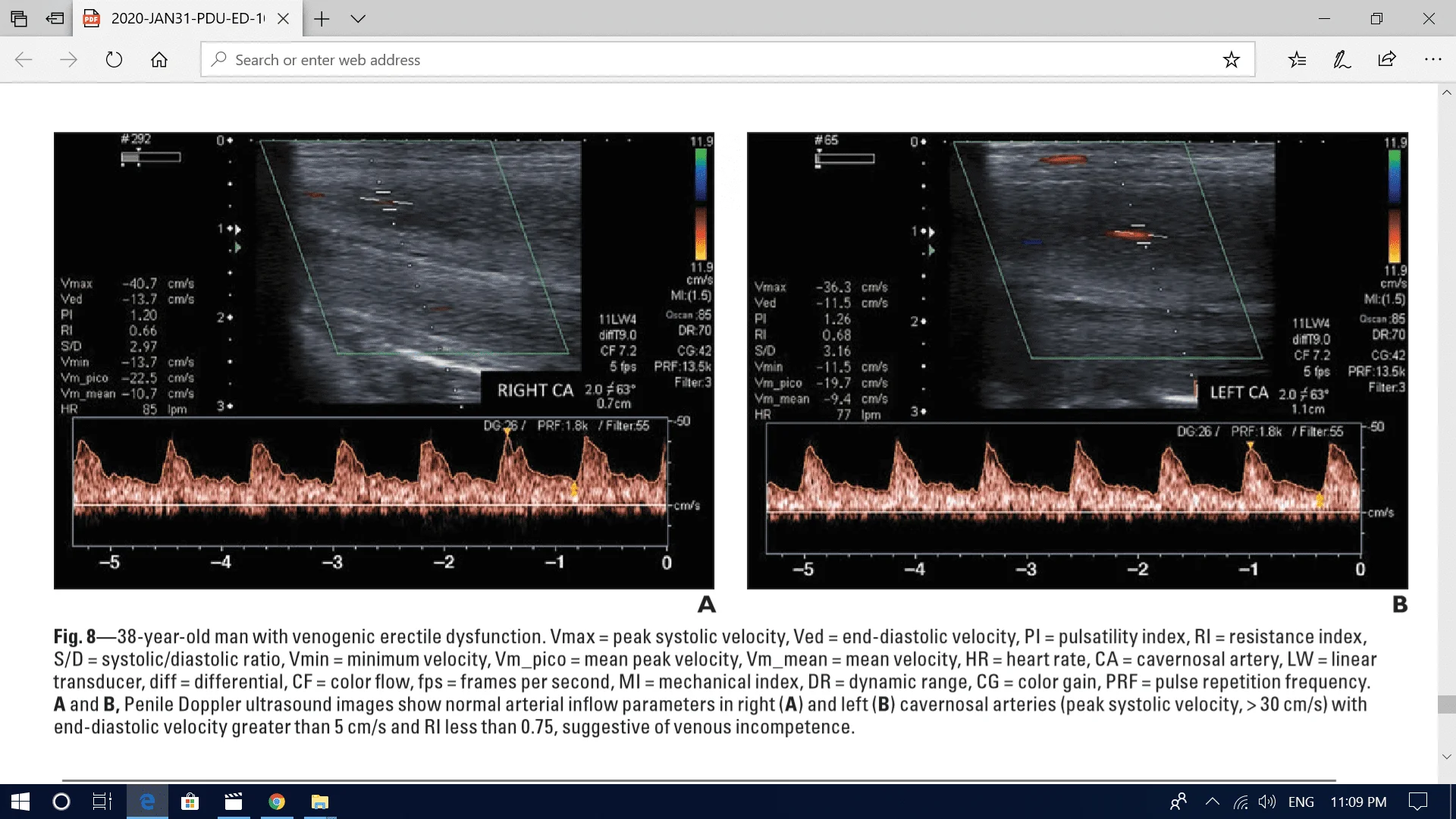 Penile Doppler Ultrasound for Erectile Dysfunction: | Excel Male TRT Forum