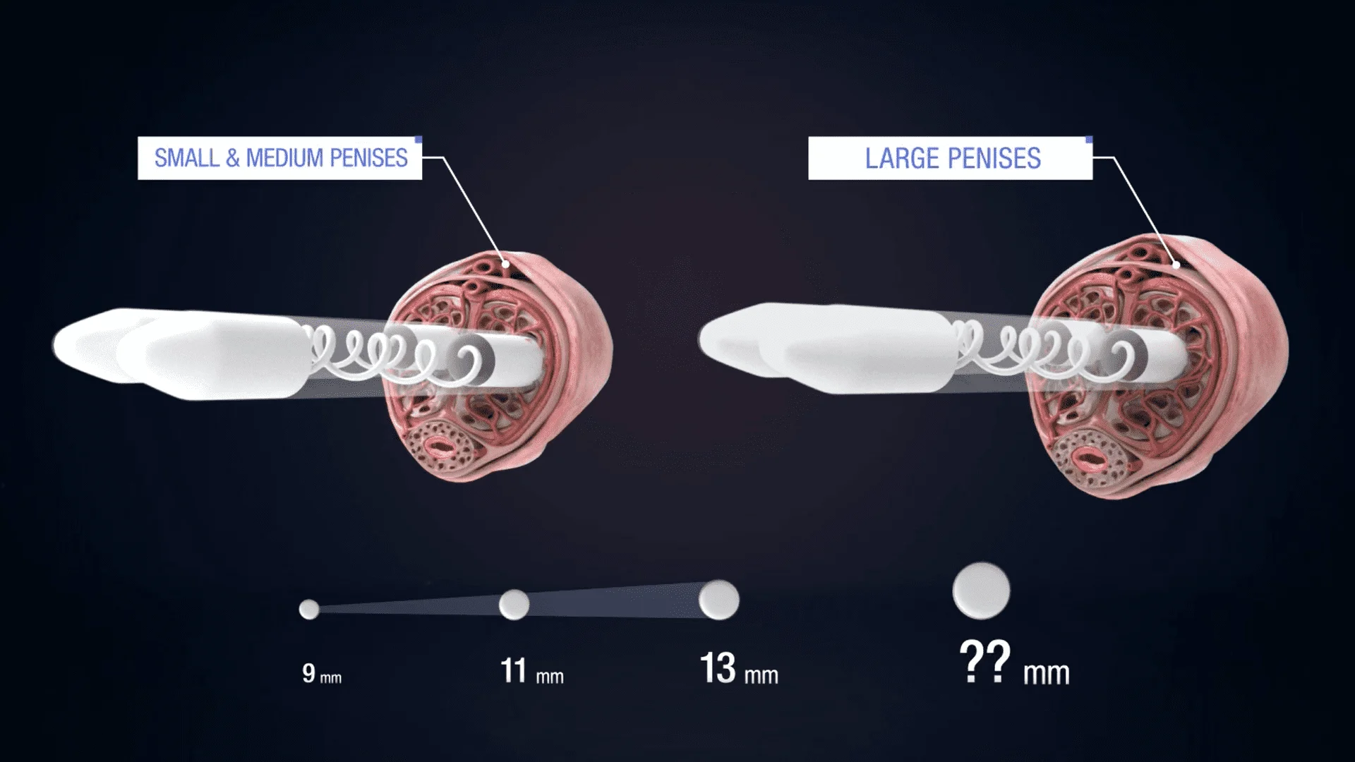 Ghattas technique: A modified malleable penile prosthesis | Excel Male ...