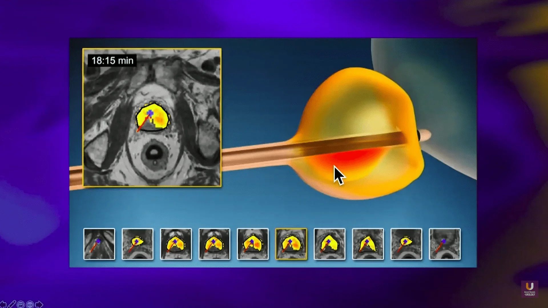 MRI-guided Transurethral Ultrasound Ablation (TULSA) for Prostate ...