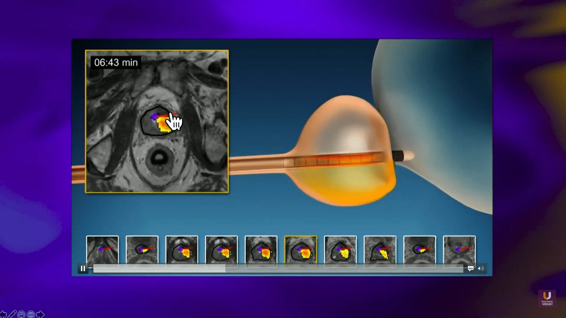 MRI-guided Transurethral Ultrasound Ablation (TULSA) for Prostate ...