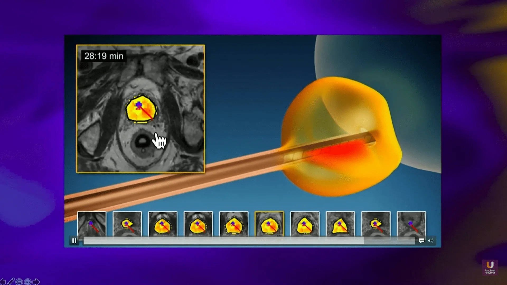 MRI-guided Transurethral Ultrasound Ablation (TULSA) for Prostate ...