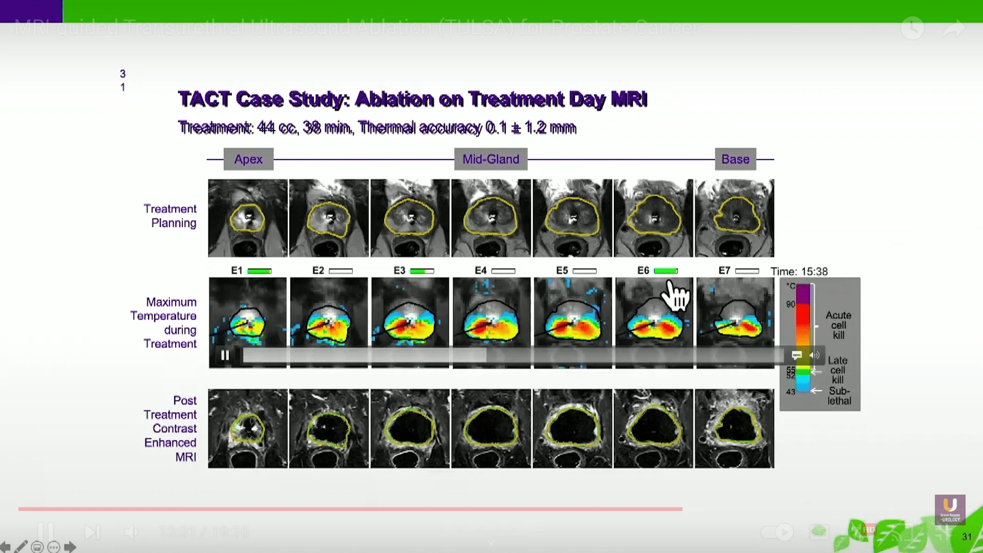 MRI-guided Transurethral Ultrasound Ablation (TULSA) for Prostate ...