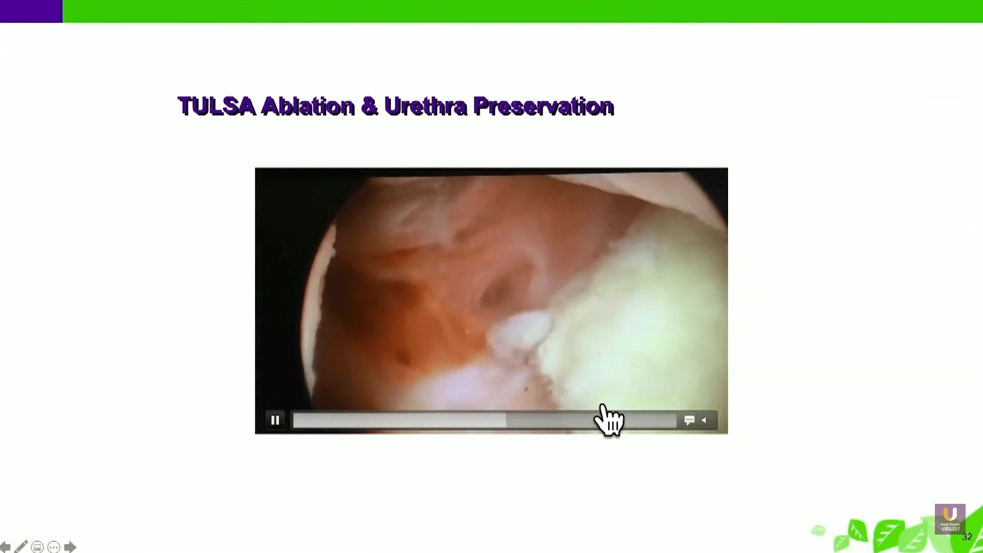 MRI-guided Transurethral Ultrasound Ablation (TULSA) for Prostate ...