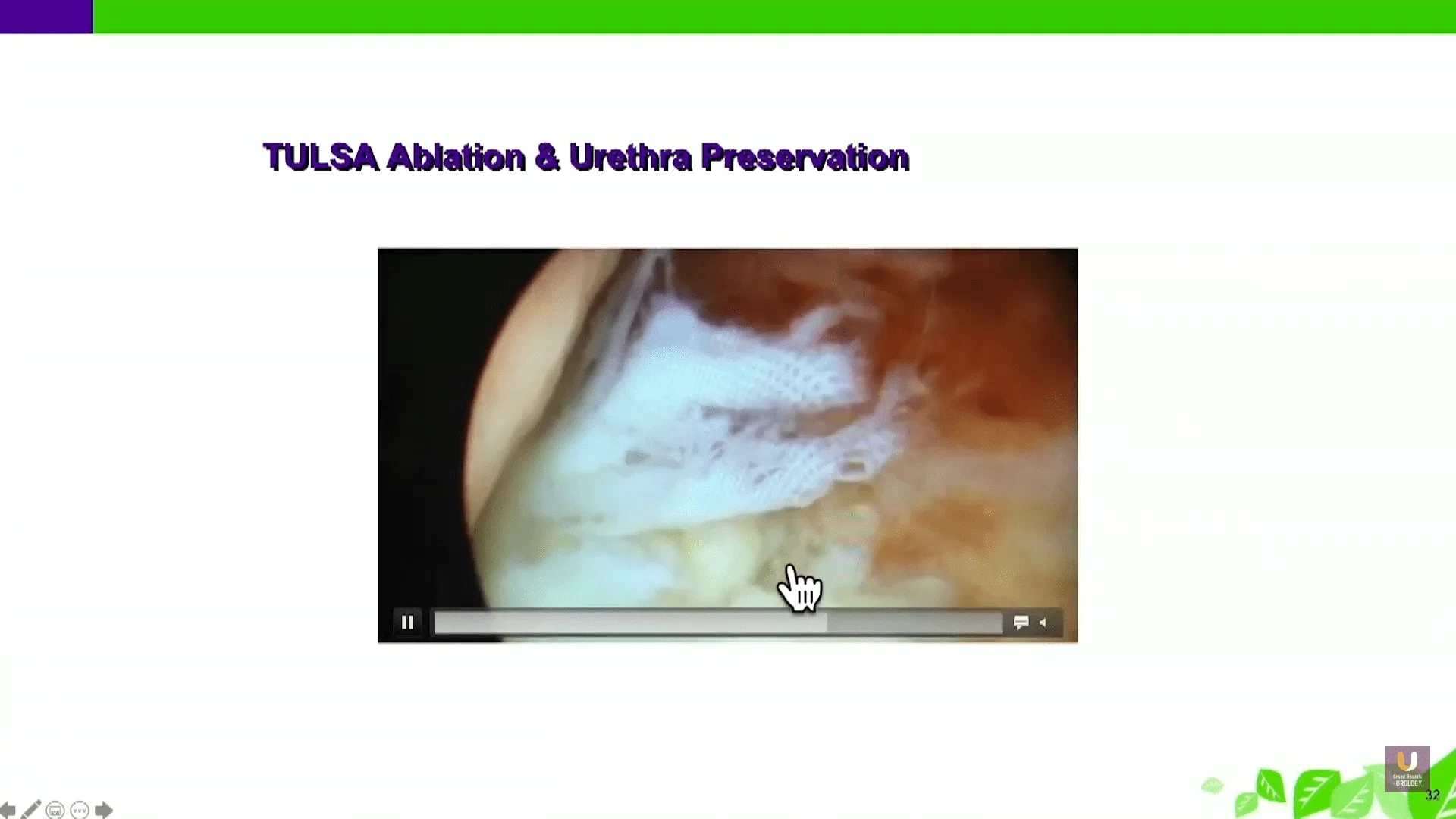 MRI-guided Transurethral Ultrasound Ablation (TULSA) for Prostate ...