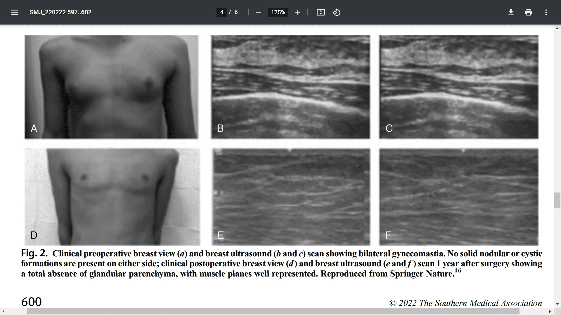 Approach to Gynecomastia in Primary Care Clinics | Excel Male TRT Forum
