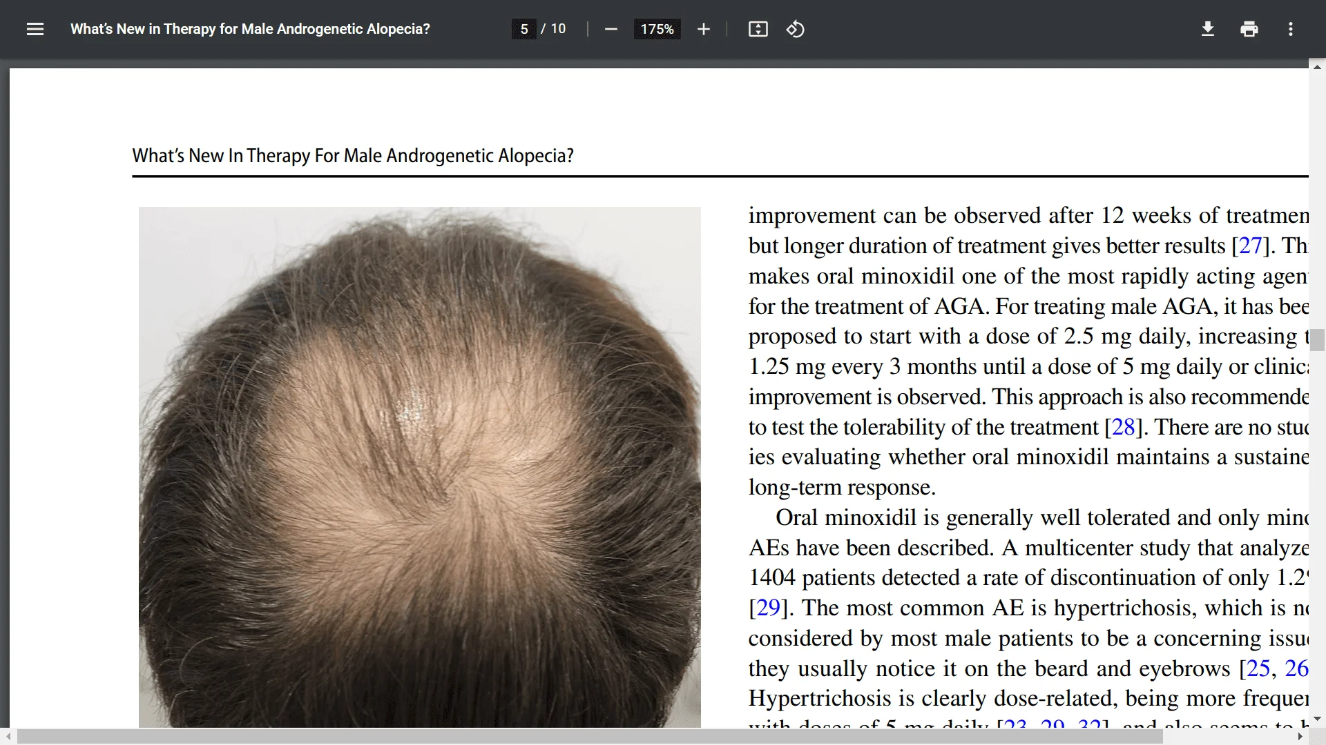 New Therapies for Male Androgenetic Alopecia? | Excel Male TRT Forum