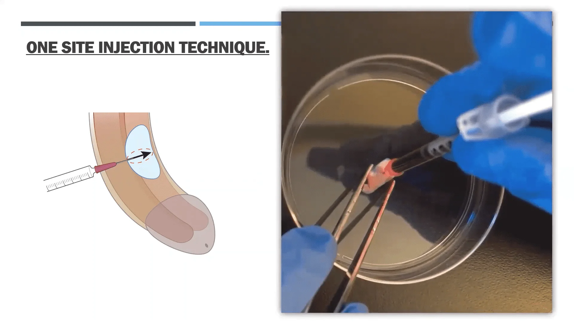 Analysis of Peyronie’s Disease Injection Techniques | Excel Male TRT Forum