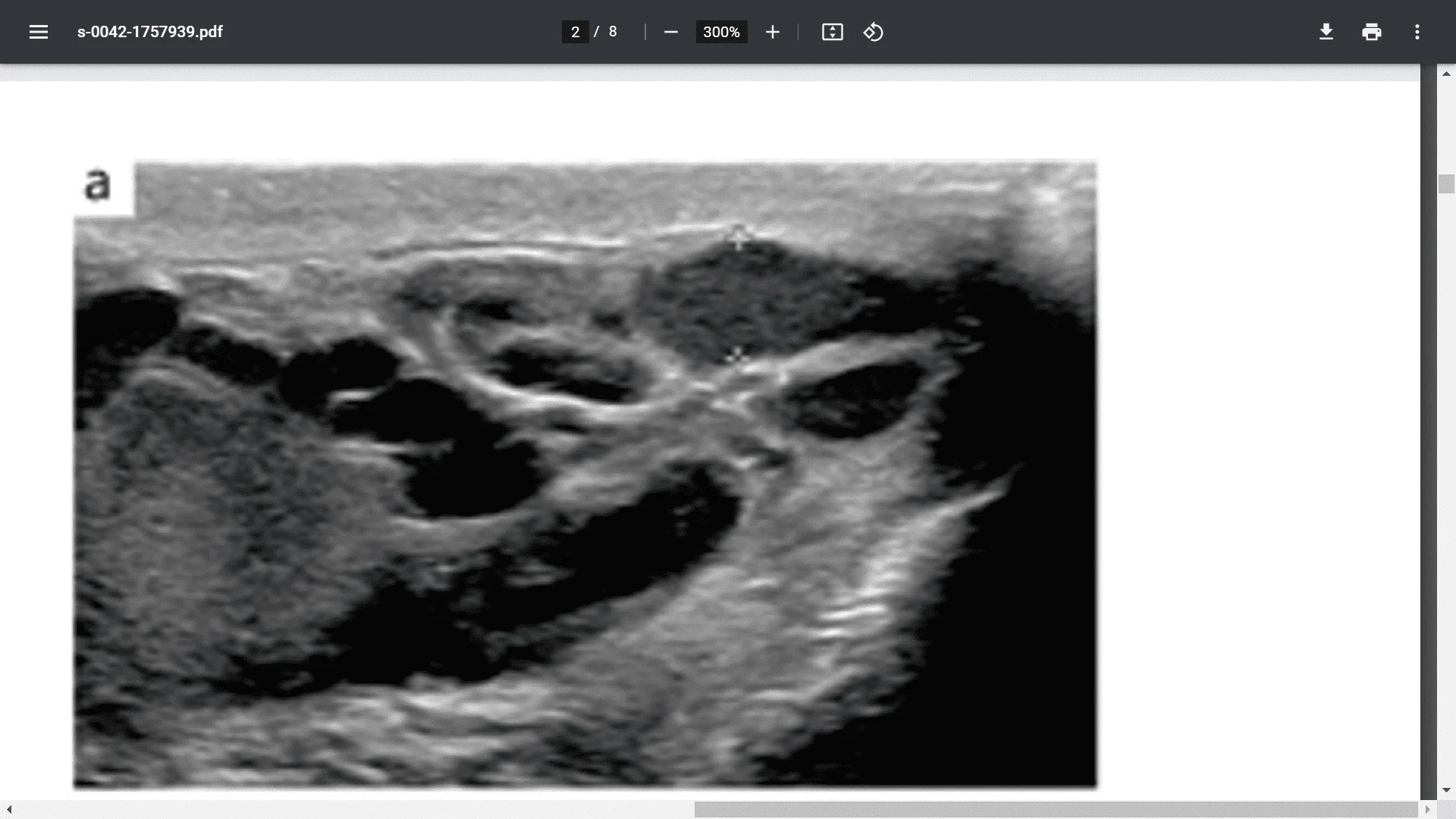 Varicoceles | Excel Male TRT Forum