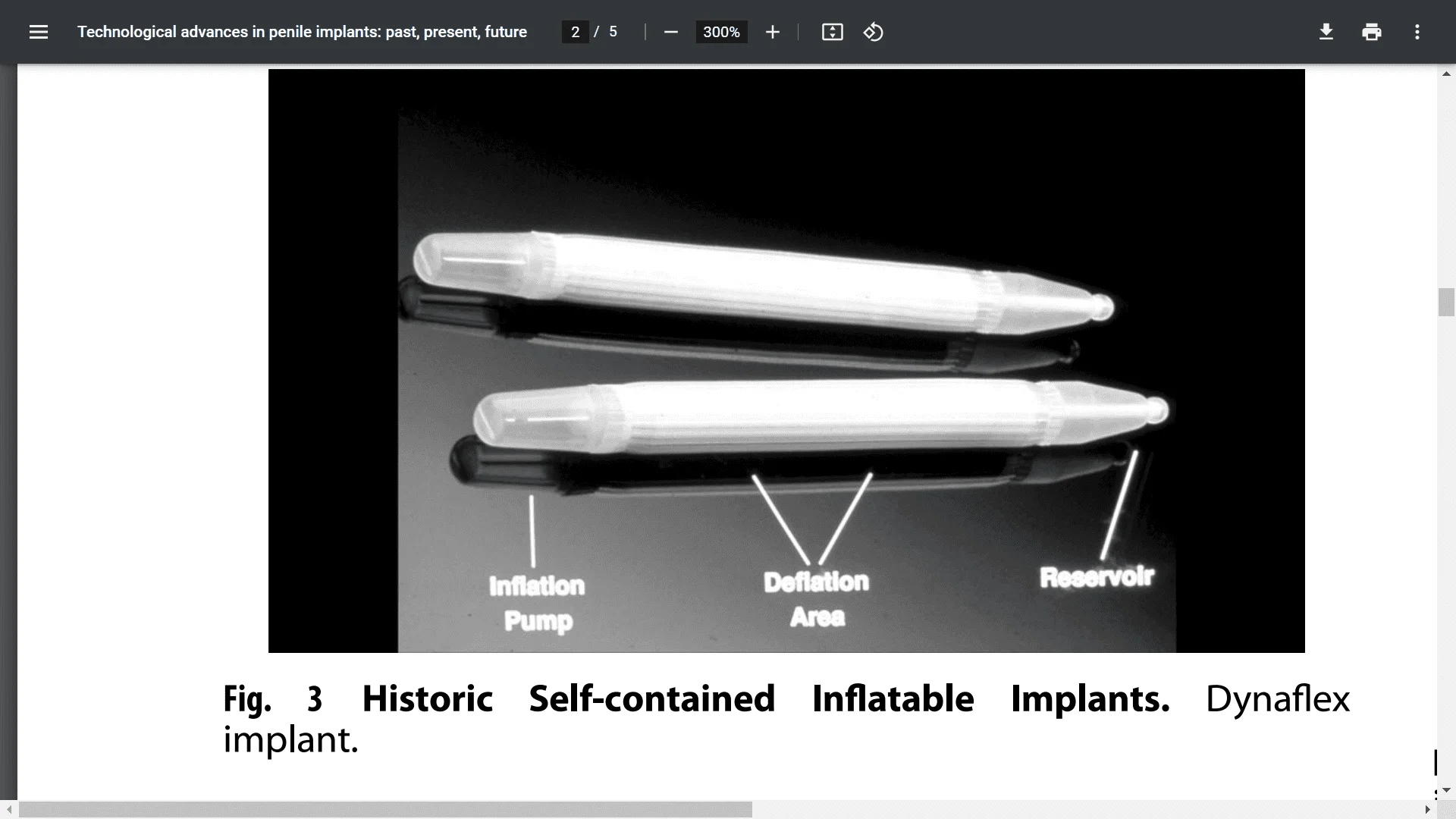 Technological advances in penile implants: past, present, future ...