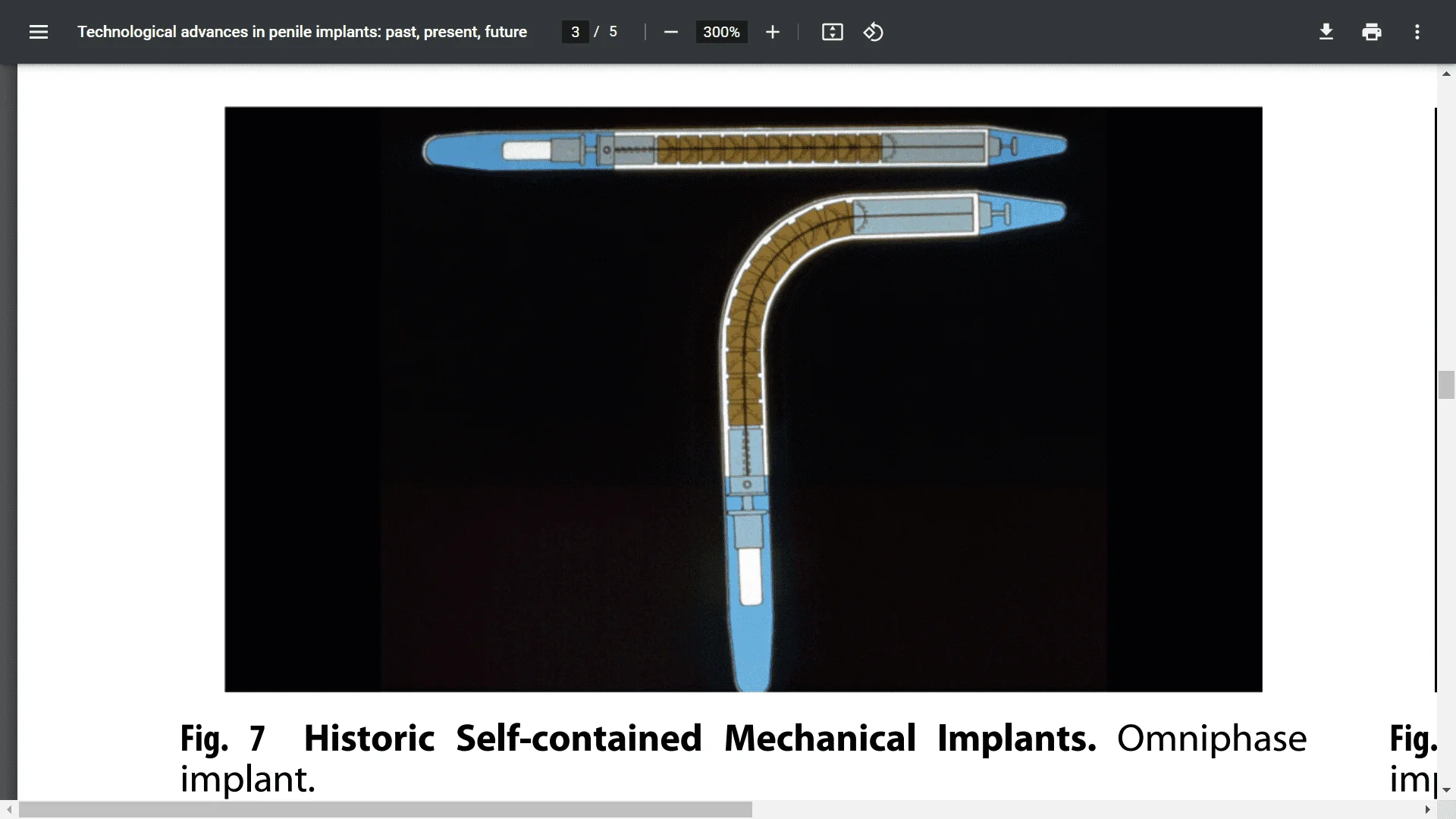 Technological advances in penile implants: past, present, future ...