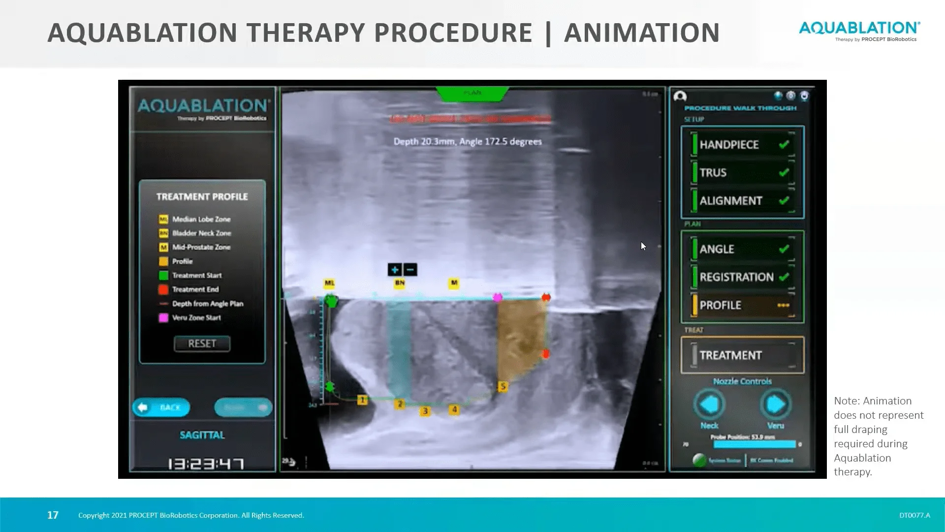 Aquablation: Revolutionizing BPH Surgery | Excel Male TRT Forum