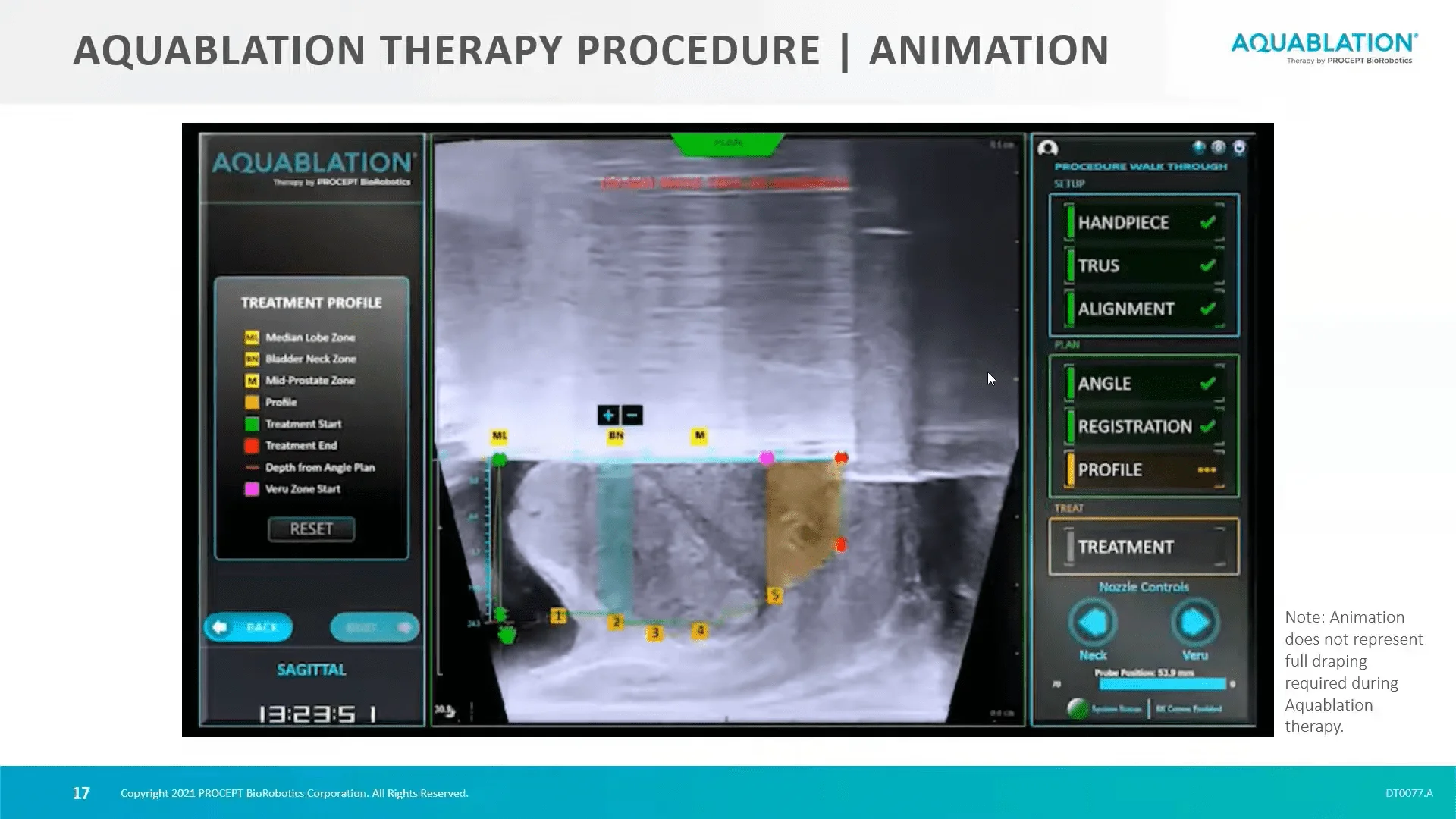 Aquablation: Revolutionizing BPH Surgery | Excel Male TRT Forum