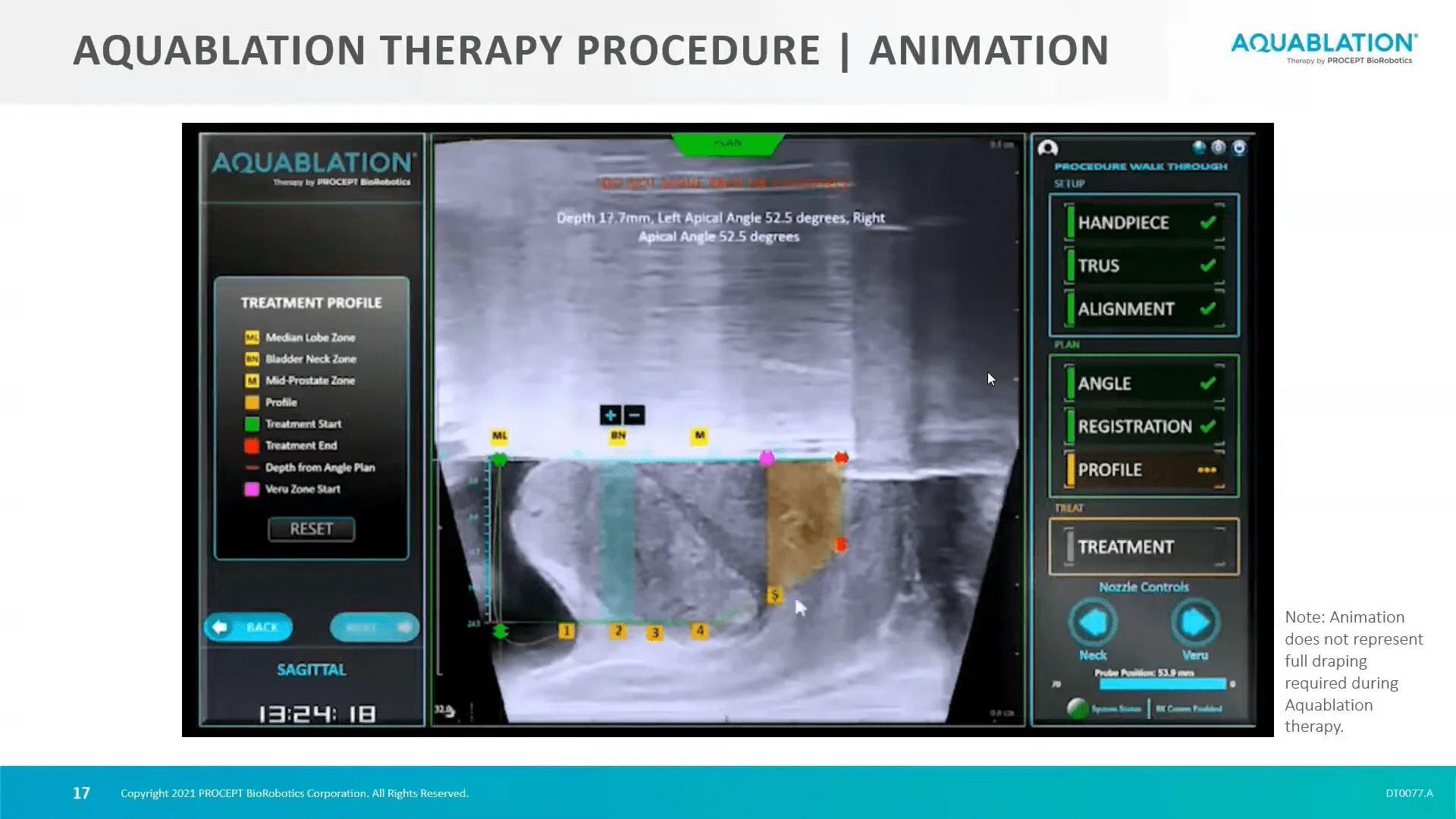 Aquablation Revolutionizing Bph Surgery Excel Male Trt Forum