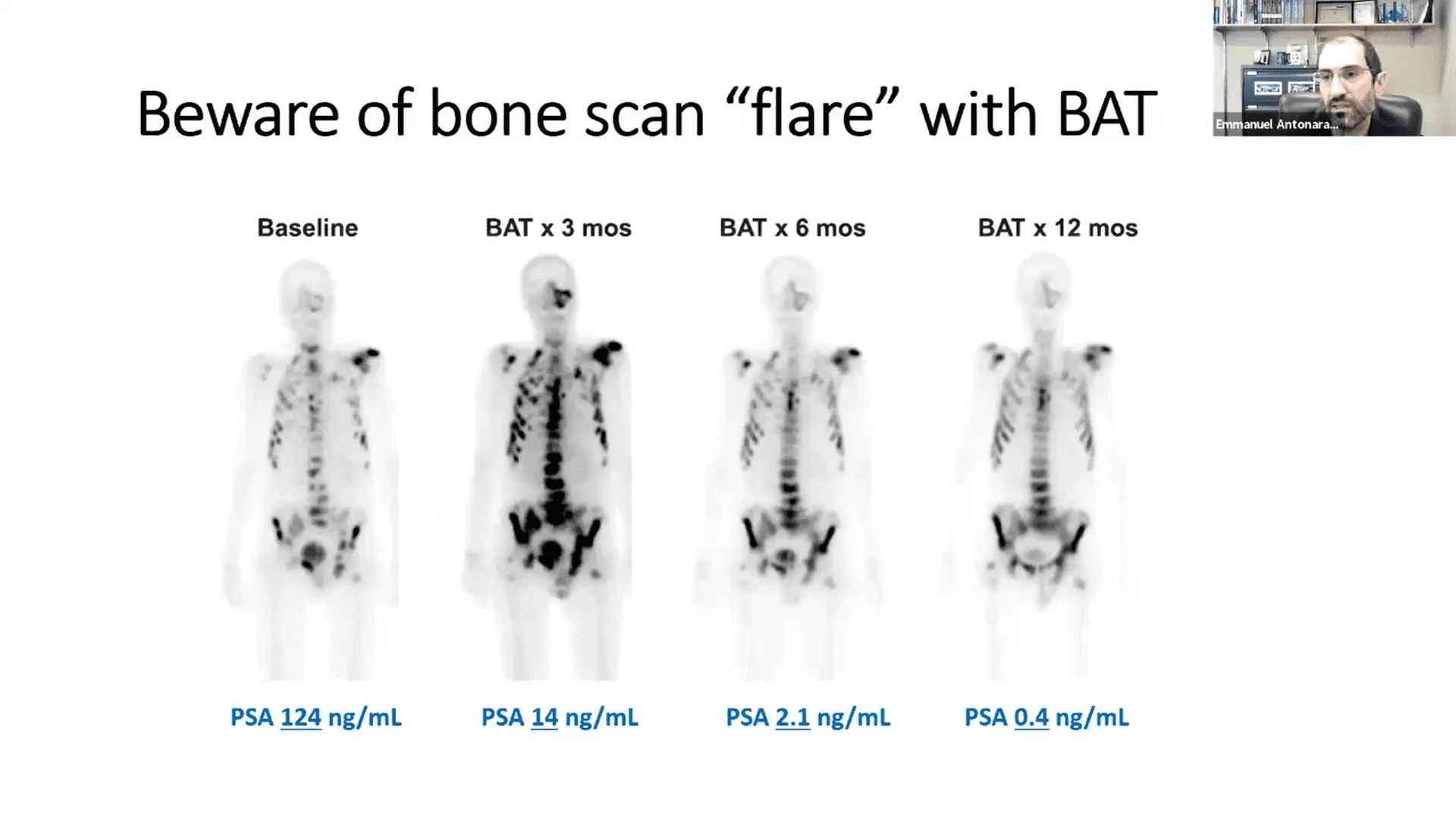Prostate Cancer: Bipolar Androgen Therapy (BAT) | Excel Male TRT Forum