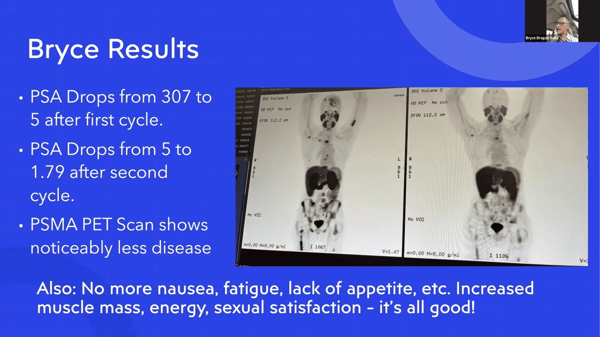 Prostate cancer: Is BAT (Bipolar Androgen Therapy) a game changer ...