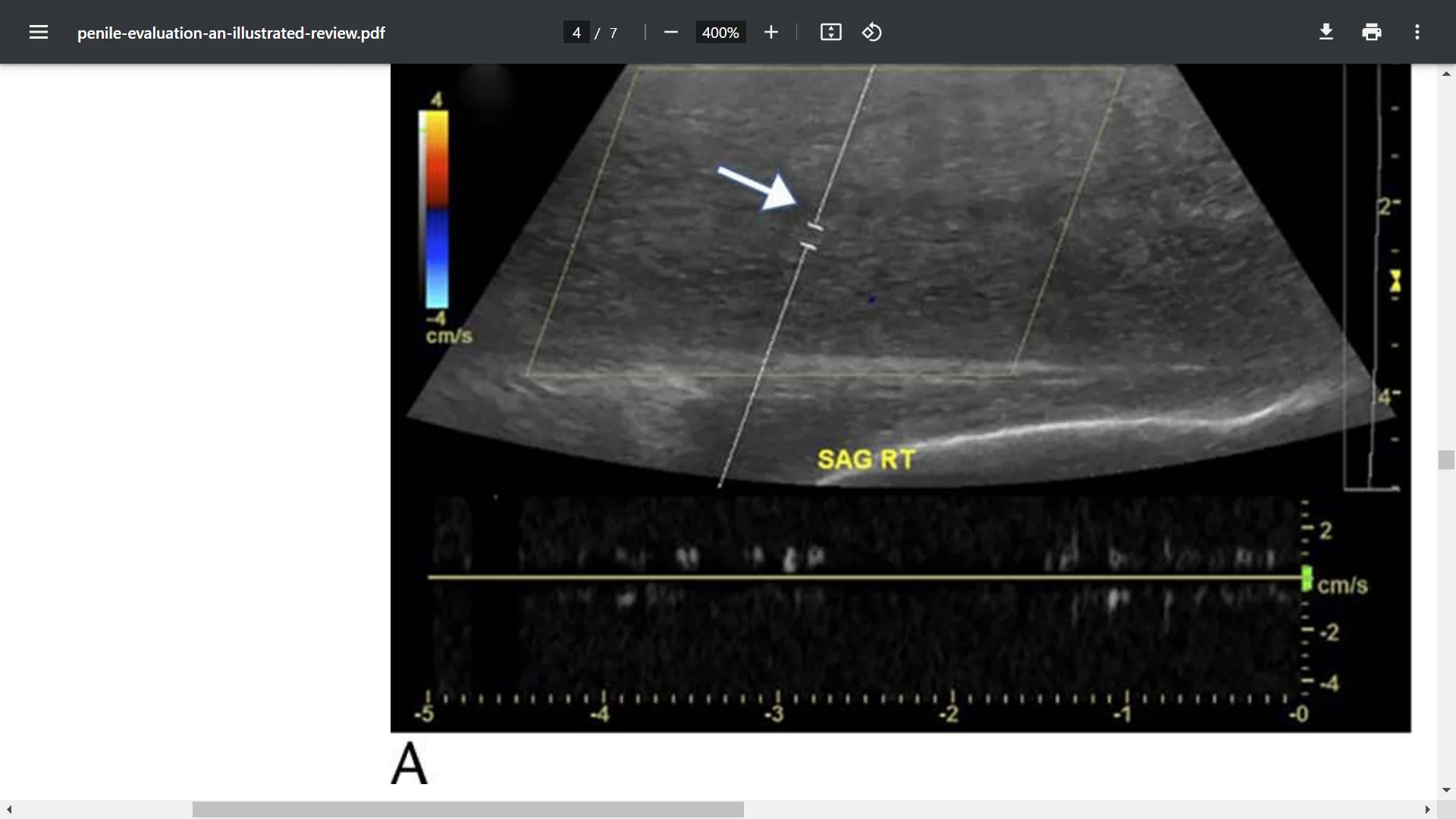 High-frequency ultrasound for penile evaluation in ED diagnosis | Excel ...