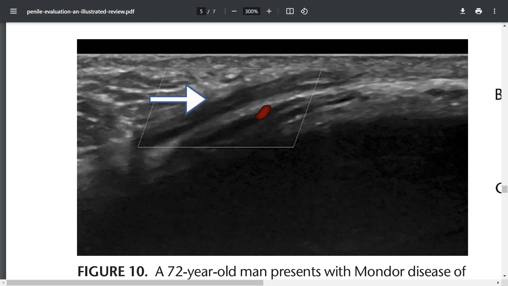 High-frequency ultrasound for penile evaluation in ED diagnosis | Excel ...