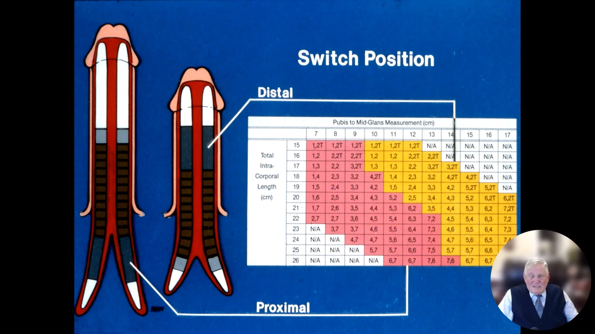 Five Decades of Experience with the Development of Penile Prosthesis ...