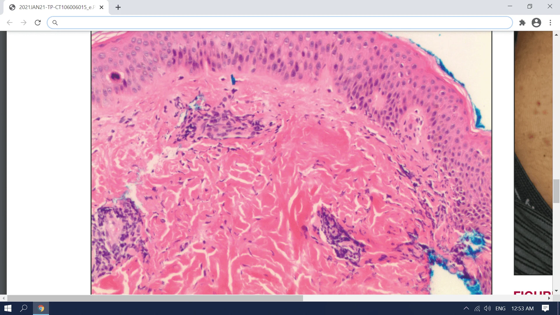 Testosterone Pellet–Induced Dermatitis | Excel Male TRT Forum