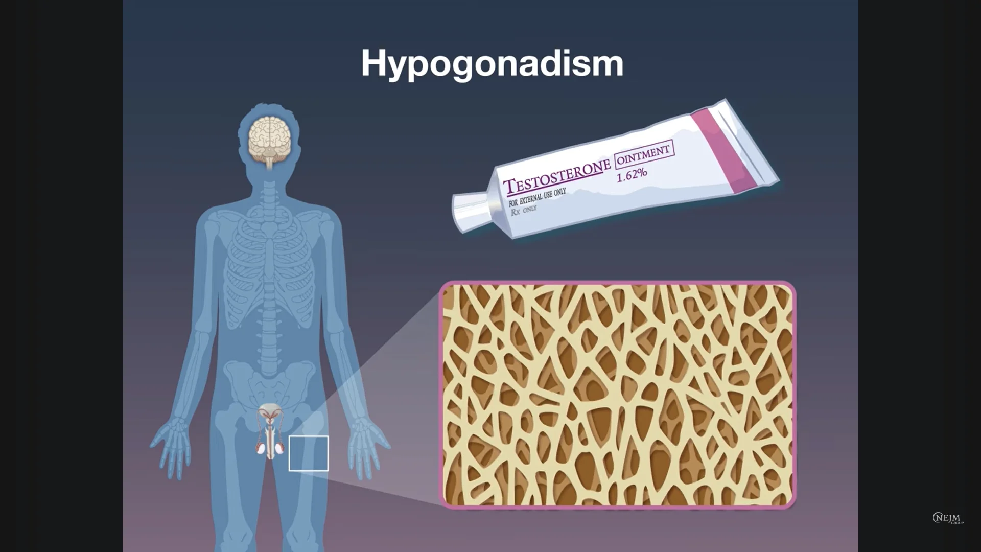 Testosterone Treatment and Fractures in Hypogonadism | Excel Male TRT Forum