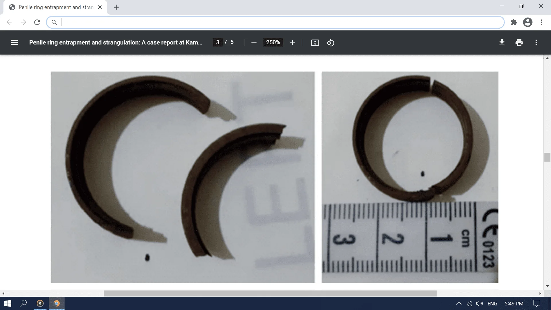 Penile ring entrapment and strangulation | Excel Male TRT Forum