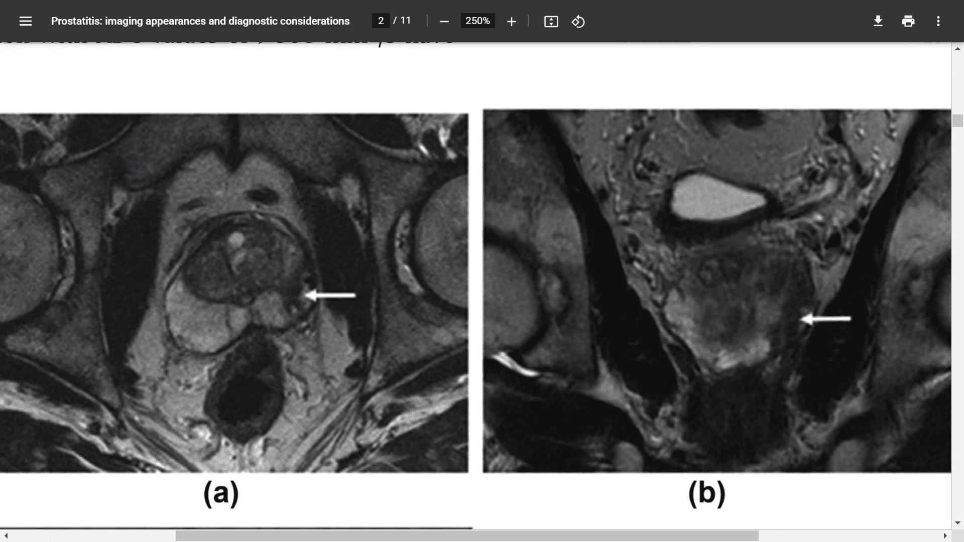 Prostatitis Imaging Appearances And Diagnostic Considerations Excel
