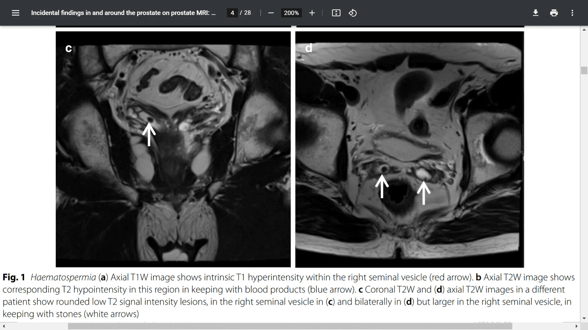Incidental findings in and around the prostate on prostate MRI | Excel ...