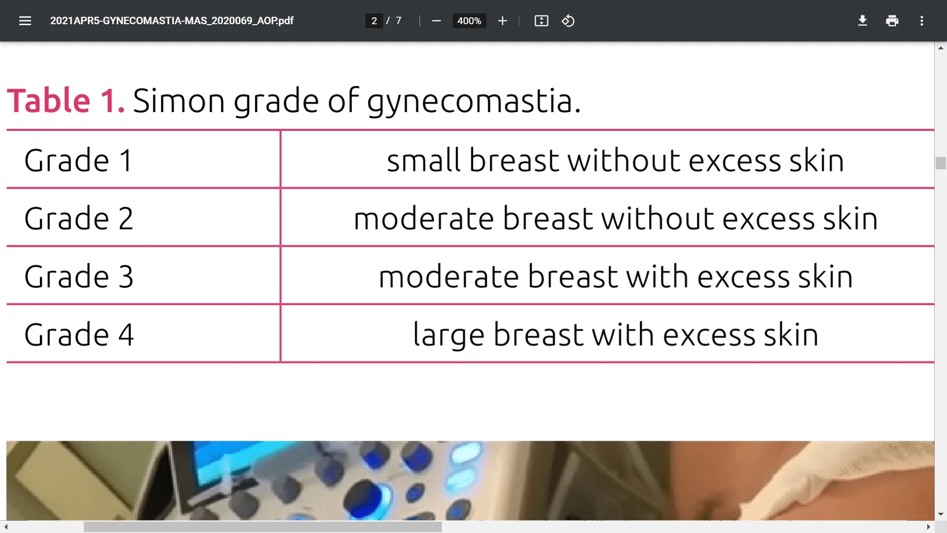 Minimally invasive treatment of gynecomastia by ultrasound-guided ...