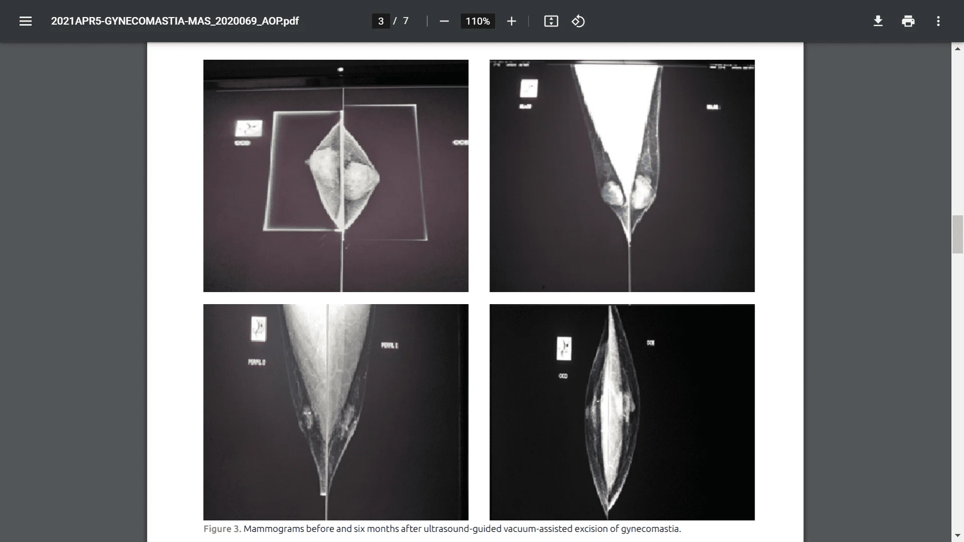 Minimally invasive treatment of gynecomastia by ultrasound-guided ...