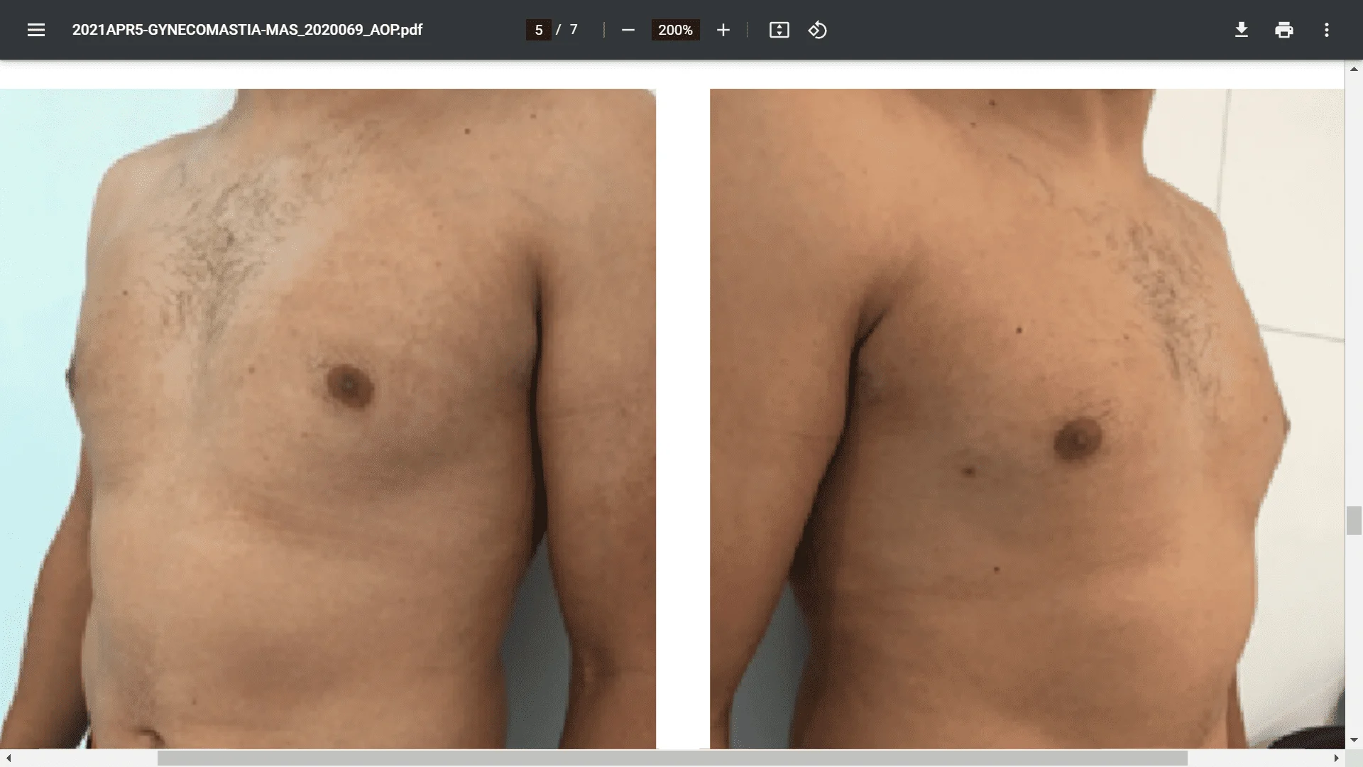 Minimally invasive treatment of gynecomastia by ultrasound-guided ...