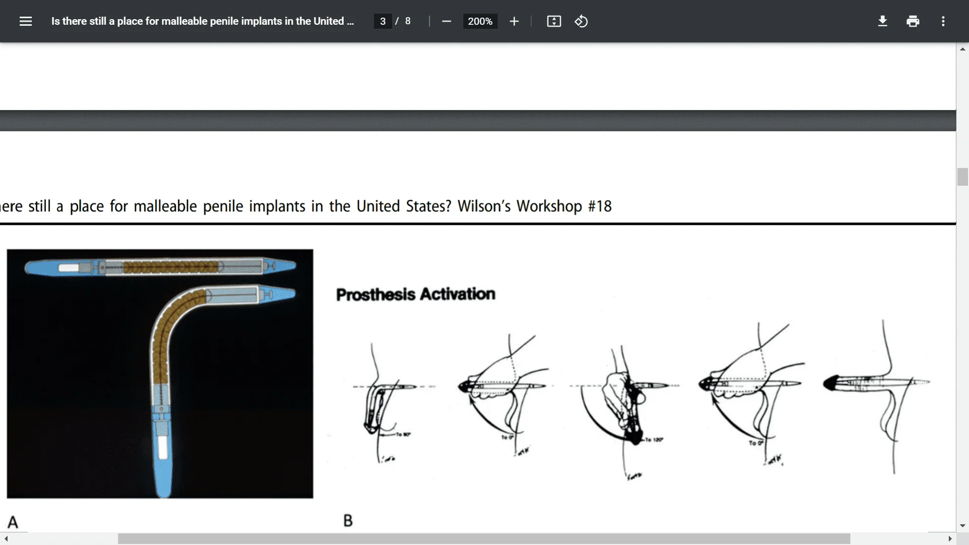 Is there still a place for malleable penile implants in the United ...