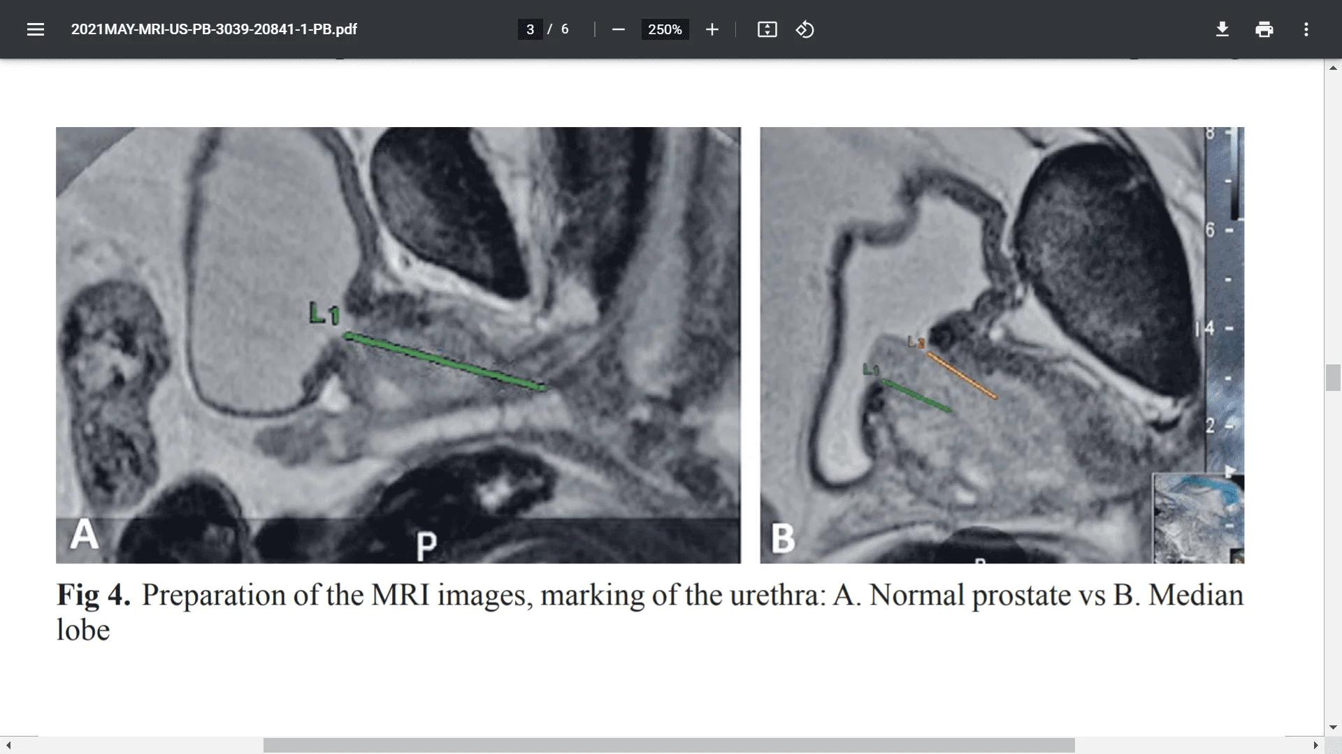 MRI-US fusion guided prostate biopsy | Excel Male TRT Forum