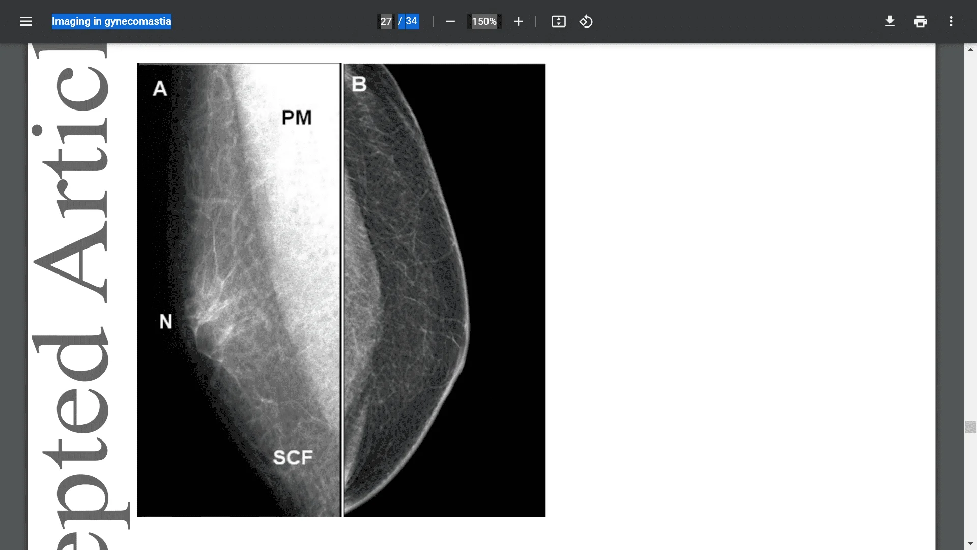 Imaging in gynecomastia | Excel Male TRT Forum