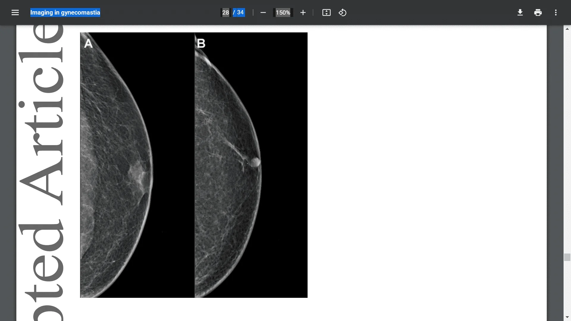 Imaging in gynecomastia | Excel Male TRT Forum
