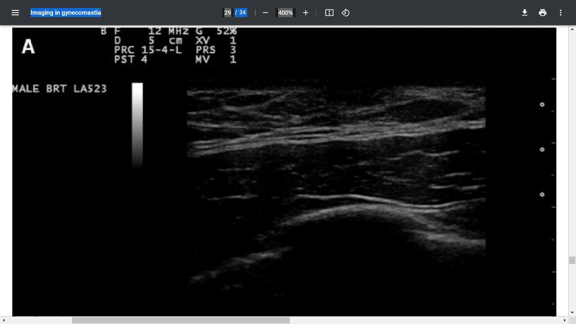 Imaging in gynecomastia | Excel Male TRT Forum