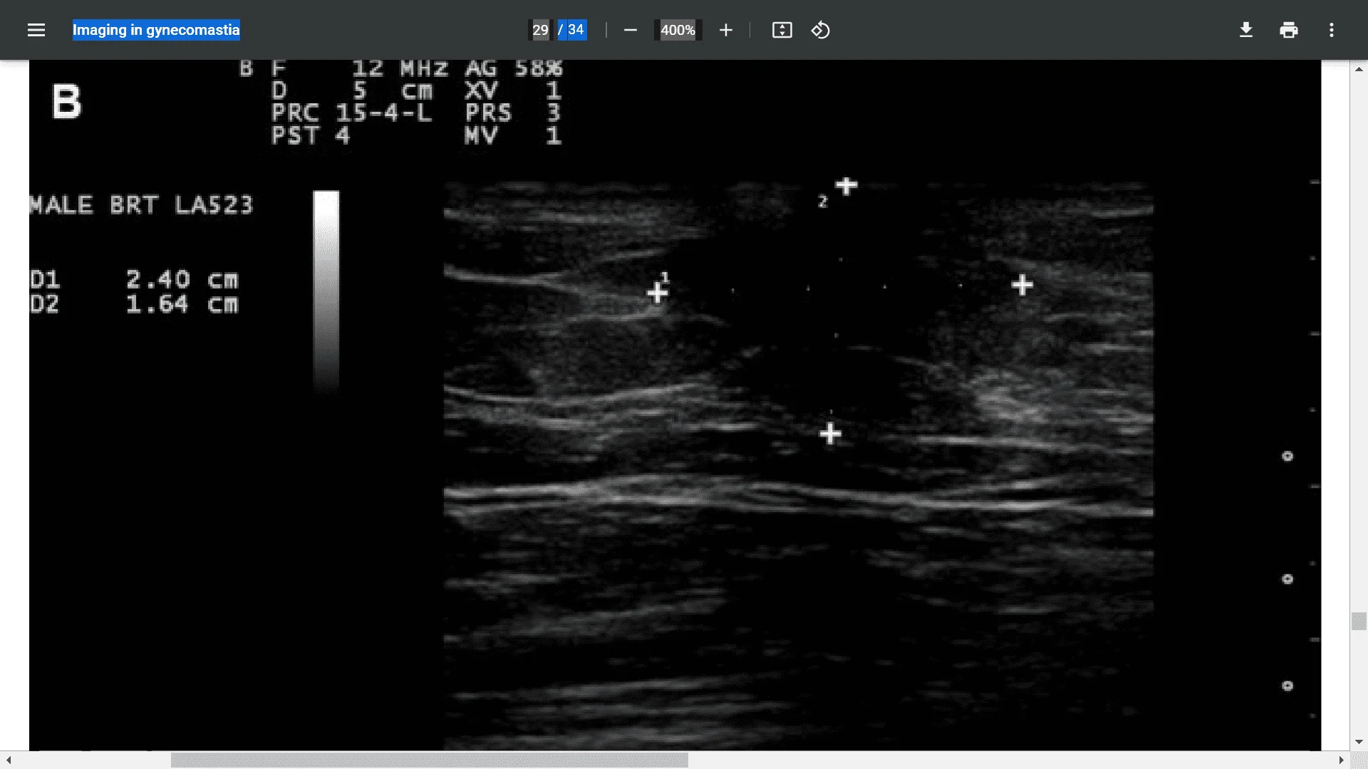 Imaging in gynecomastia | Excel Male TRT Forum