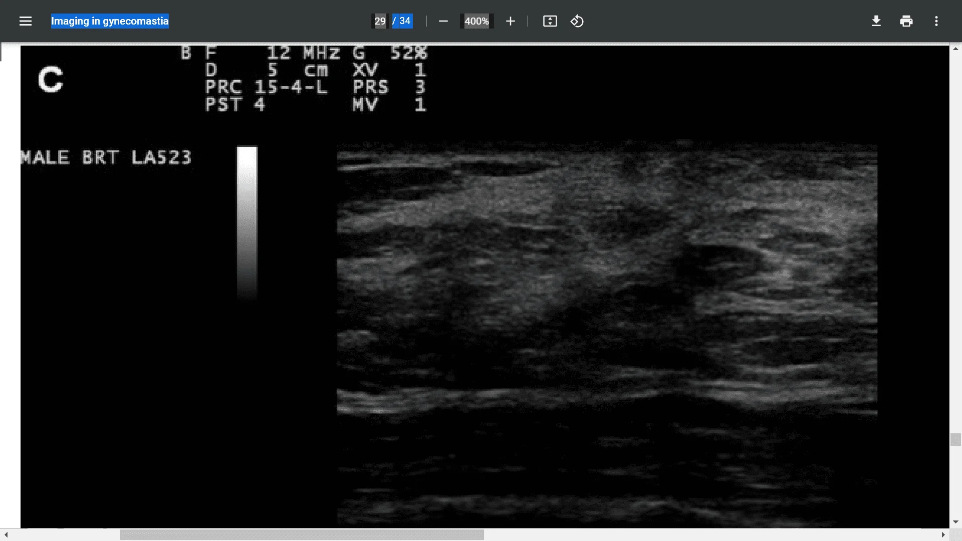 Imaging in gynecomastia | Excel Male TRT Forum