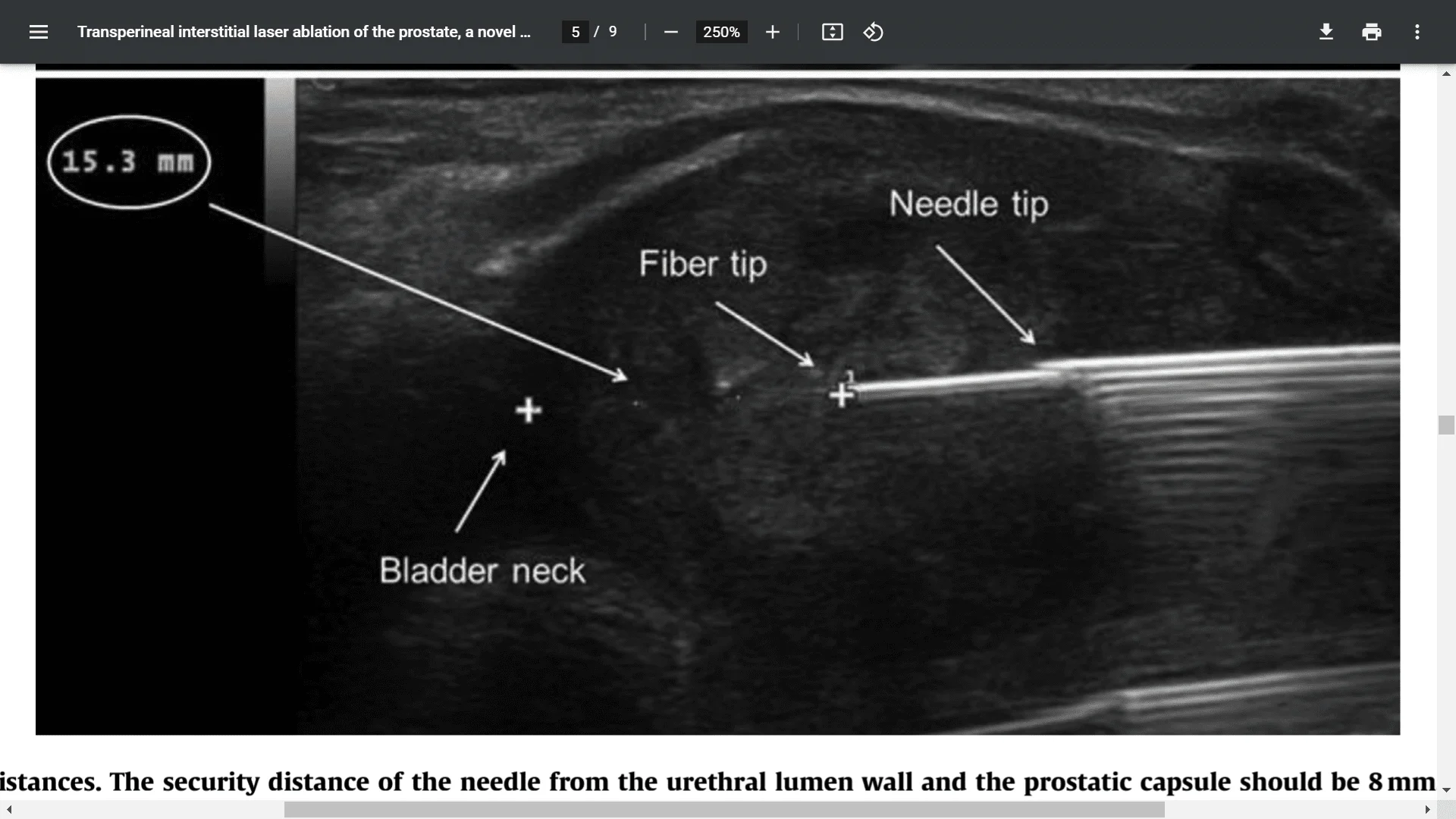 Transperineal interstitial laser ablation of the prostate, a novel ...