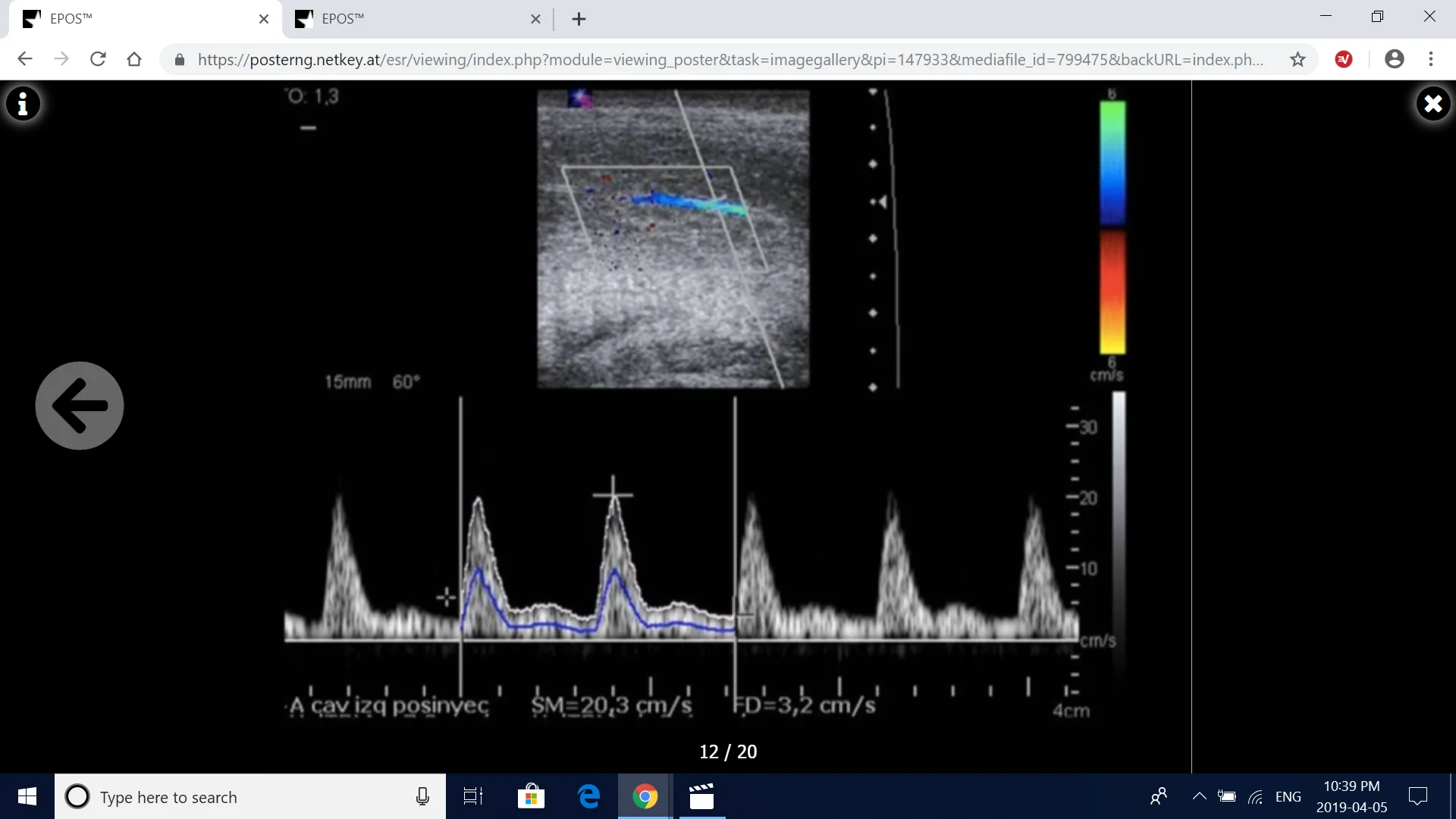Radiologic Approach to Erectile Dysfunction. Main causes, diagnosis and ...