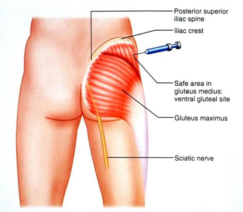 How To Do Ventrogluteal Injection - Glute Injection Guide And Demo